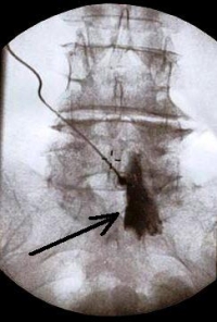 Epidural Steroid Injections | Selective Nerve Root Blocks