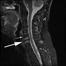 Isolated Disc Resorption (IDR) | Cervical Spine | Spine Specialist