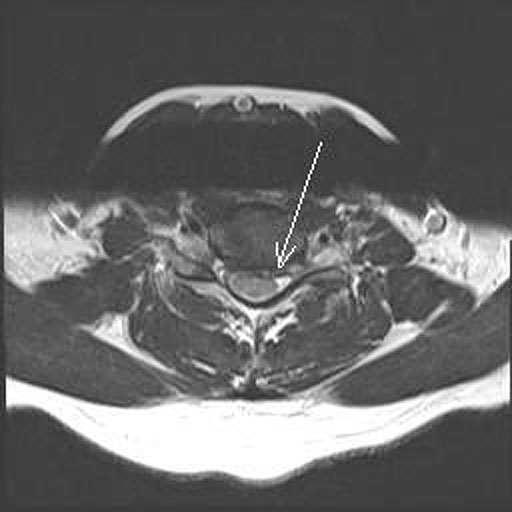 Anterior Cervical Decompression & Fusion (ACDF) | Spine Surgeon