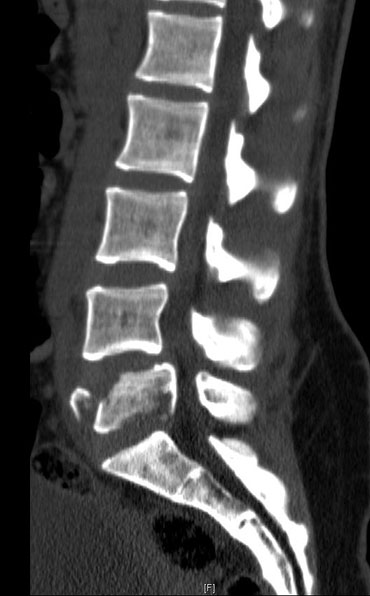 Thoraco-Lumbar Spine Fractures | Spine Specialist | Vail, Aspen, Denver CO