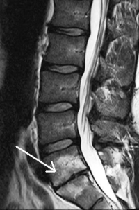 Causes of Lower Back Pain | Spine Specialist