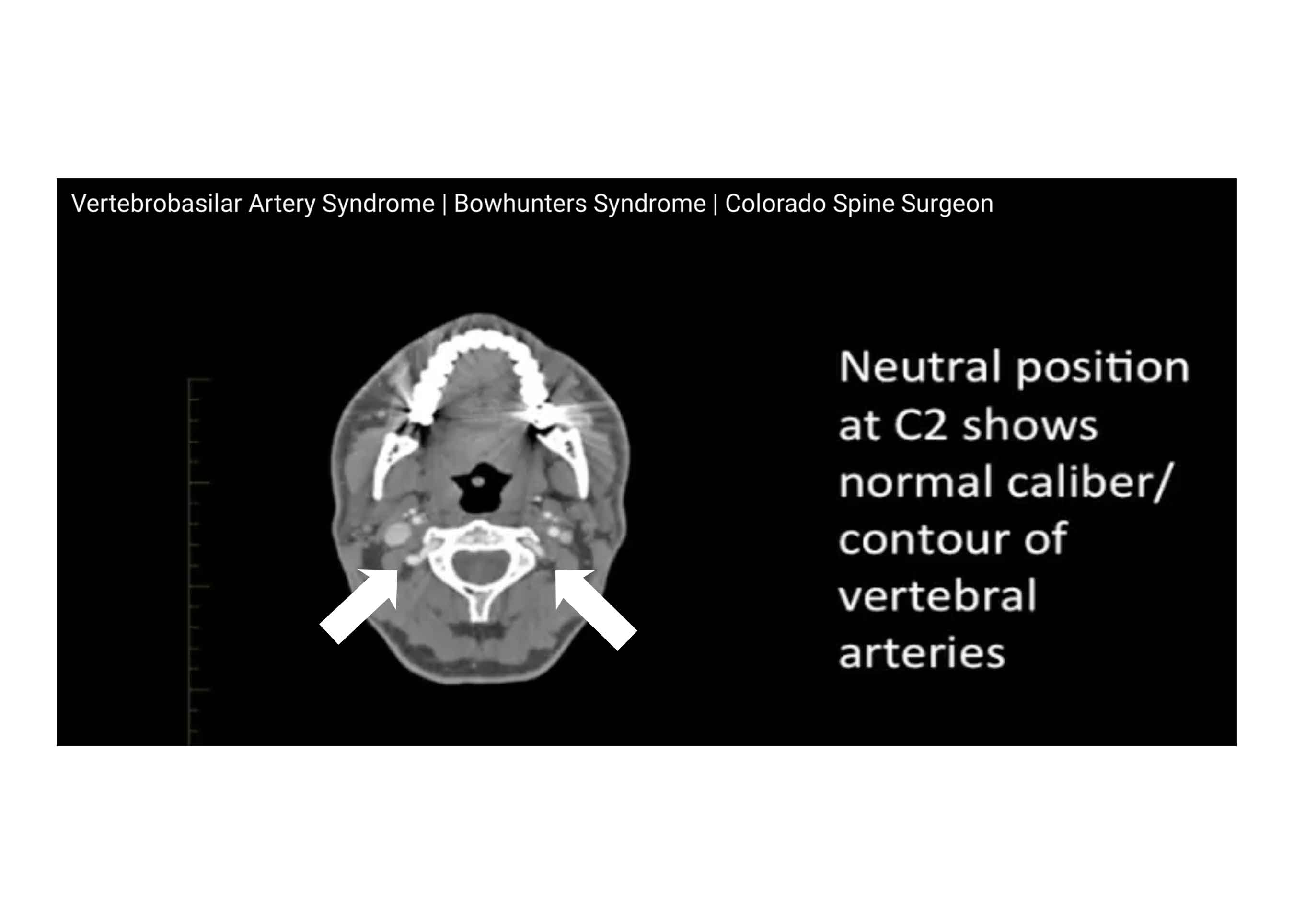 Vertebrobasilar Artery Syndrome | Vertebrobasilar Artery Ischemia ...